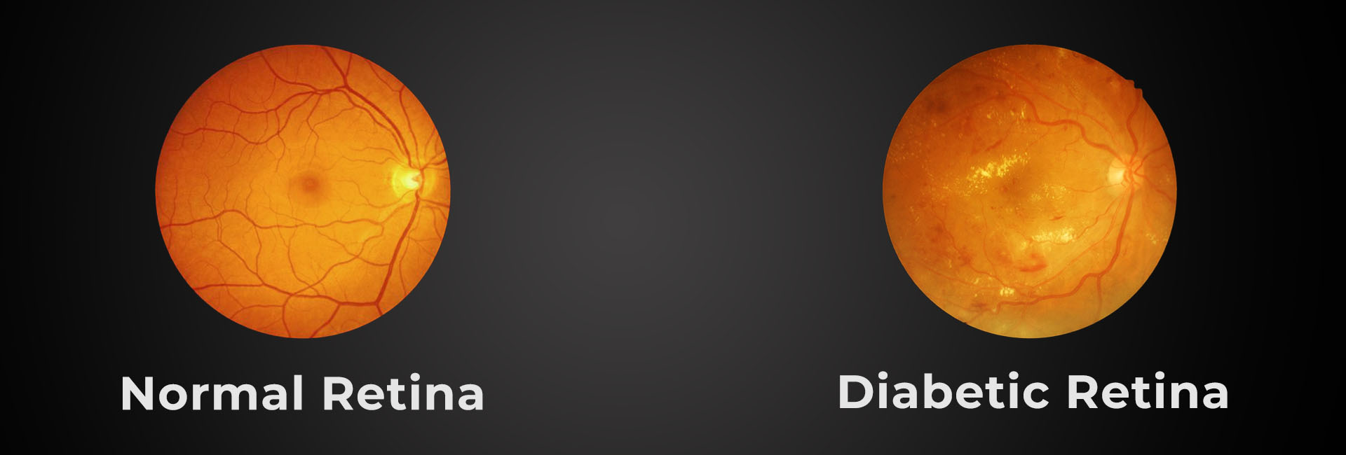 Retinal Services in Hyderabad | Global Eye Hospital