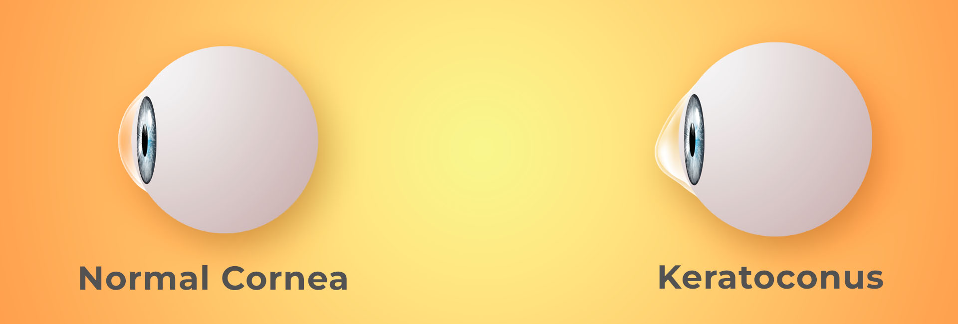 Keratoconus Treatment in Hyderabad | Corneal Specialists