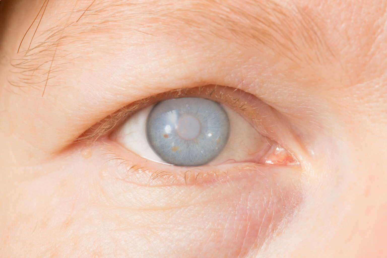 A Brief About Different Types Of Cataracts Global Eye Hospital