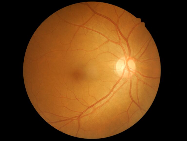 What are the types of diabetic retinopathy? - Global Eye Hospital