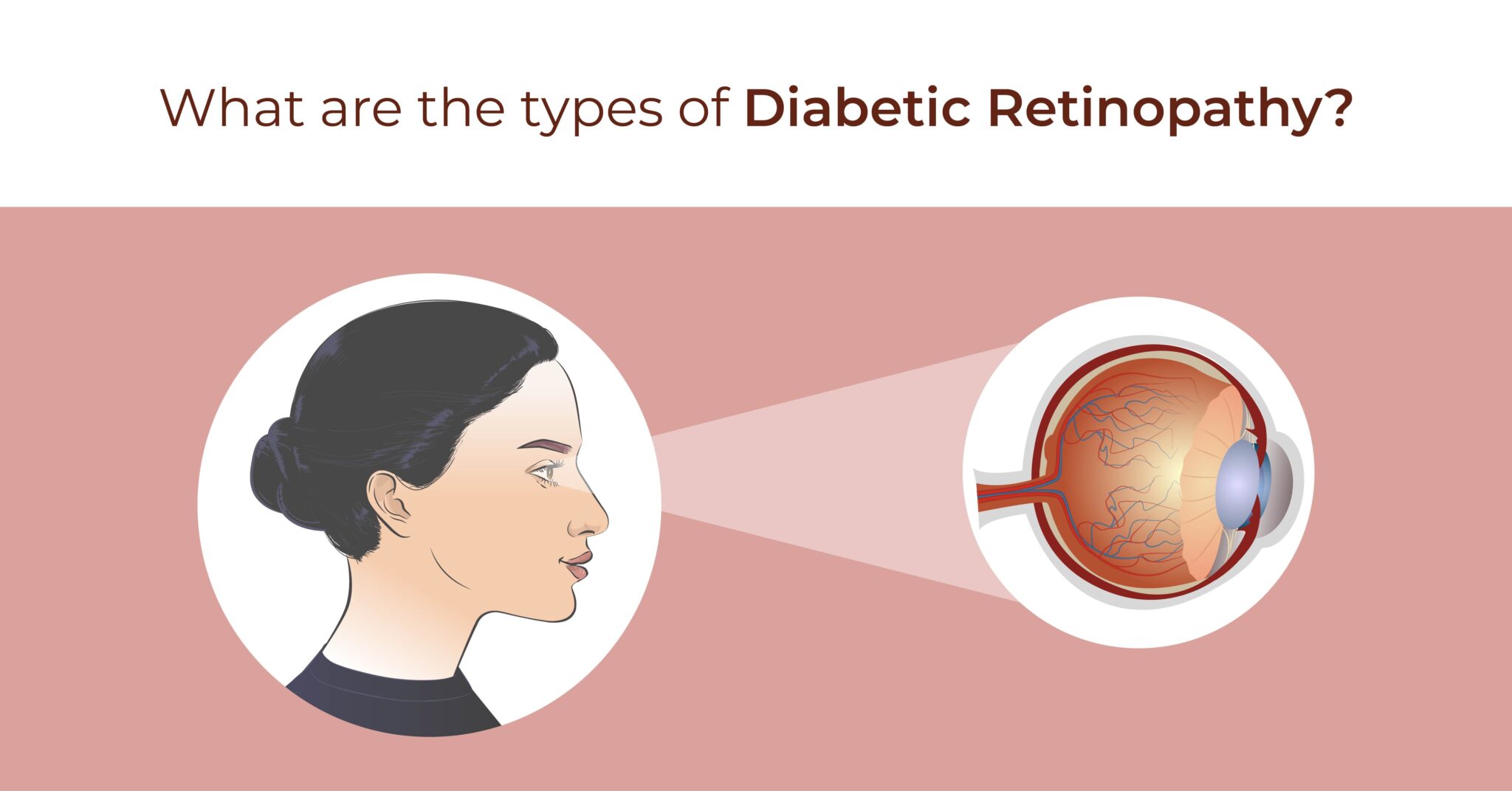 What are the types of diabetic retinopathy? - Global Eye Hospital